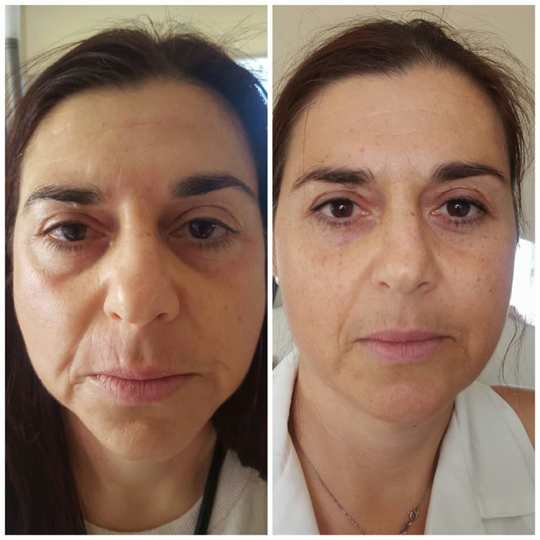 HIFU DOT LIFT – Η επαναστατικη μεθοδος για λιφτινγκ χωρις νυστερι ...